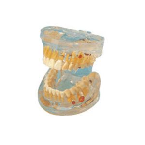 Pathological tooth transparent model-Anatomical Series