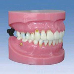 Periodontal lesions demo model-Anatomical Series